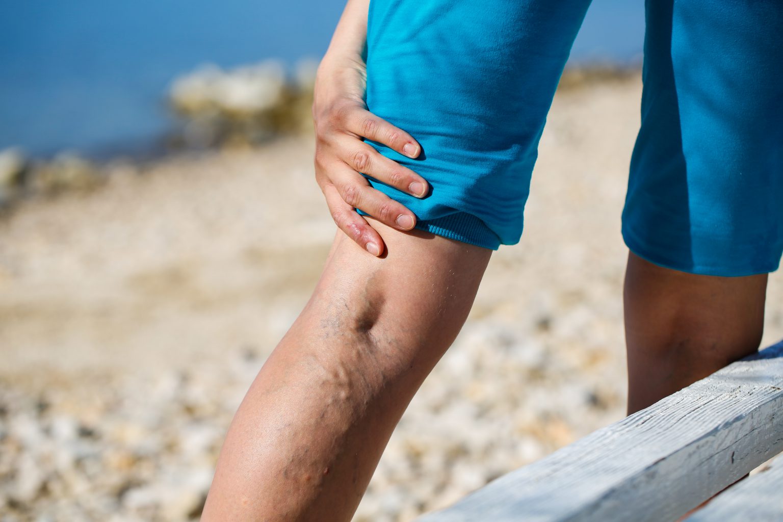 Varicose Vein Symptoms - Vantage Radiology