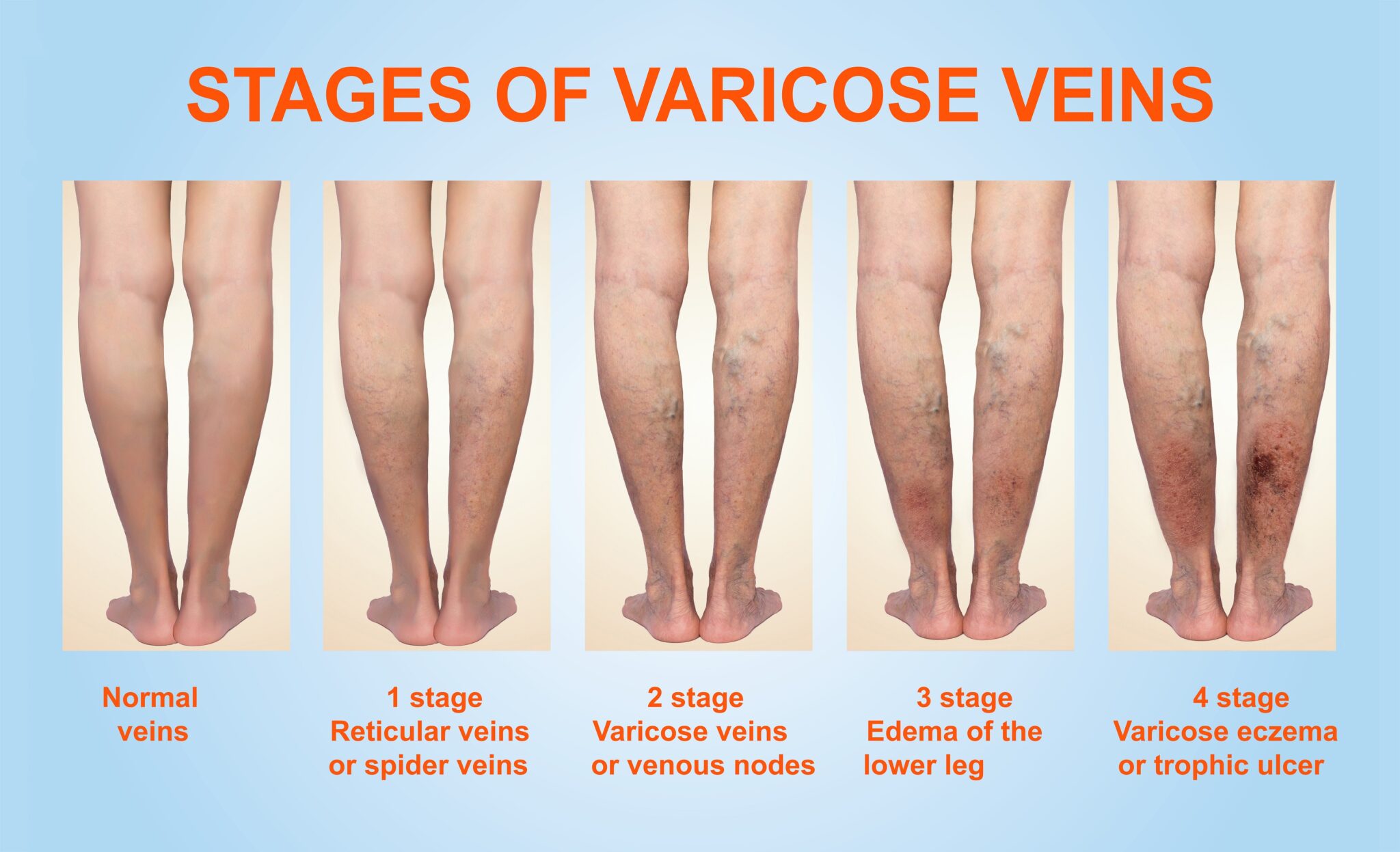 What Are the Stages of Vein Disease? - Vantage Radiology